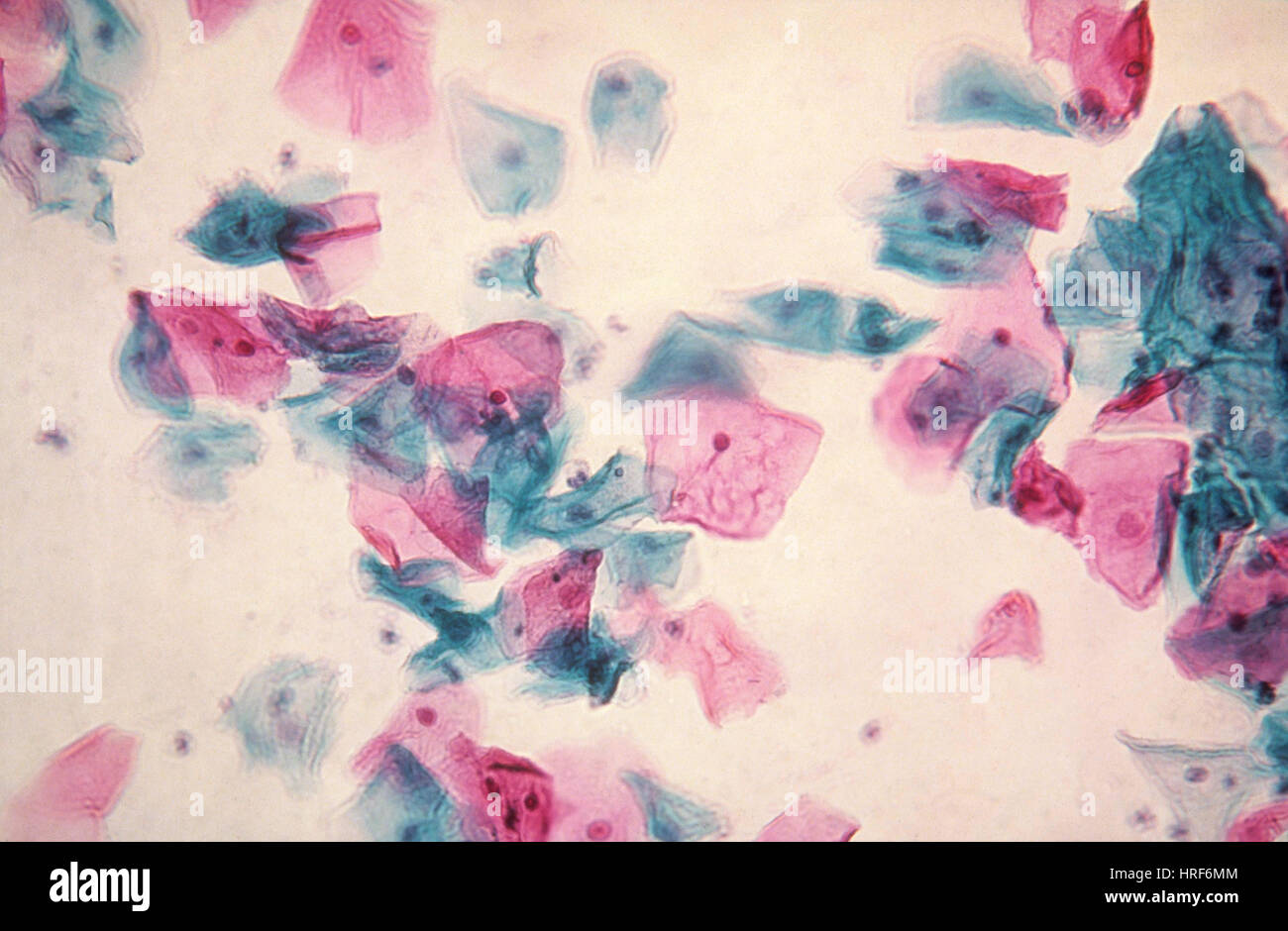 Pap test gebärmutterhalskrebs -Fotos und -Bildmaterial in hoher ...