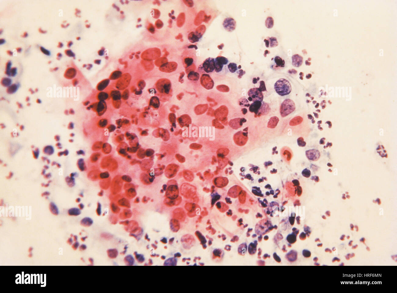 Pap Smear Cancer Stockfotos und -bilder Kaufen - Alamy