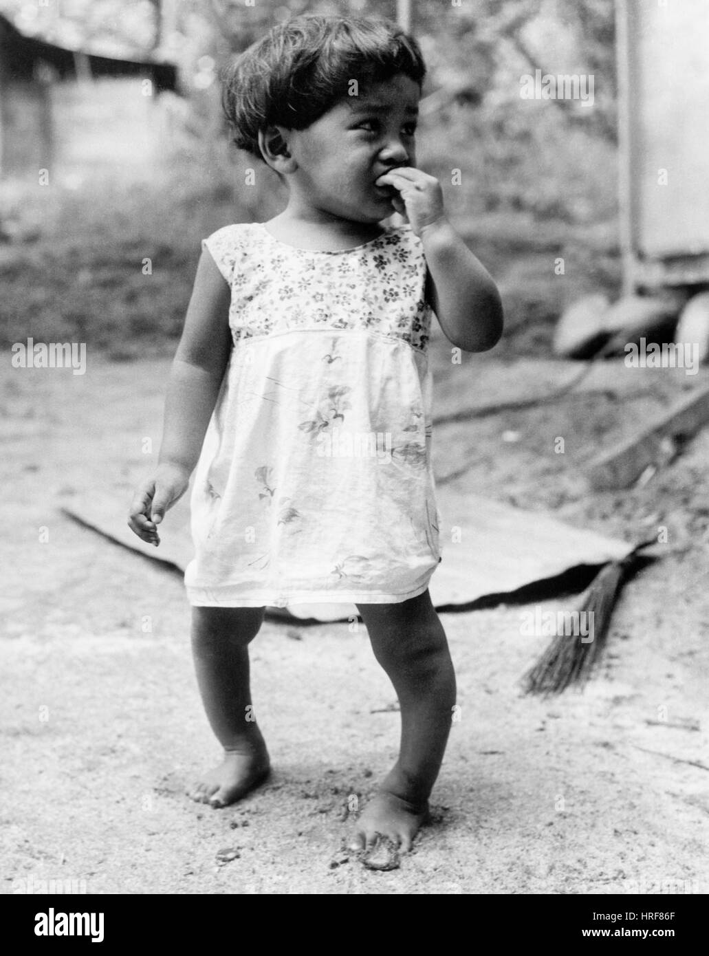 Mädchen mit Rachitis Stockfotografie - Alamy