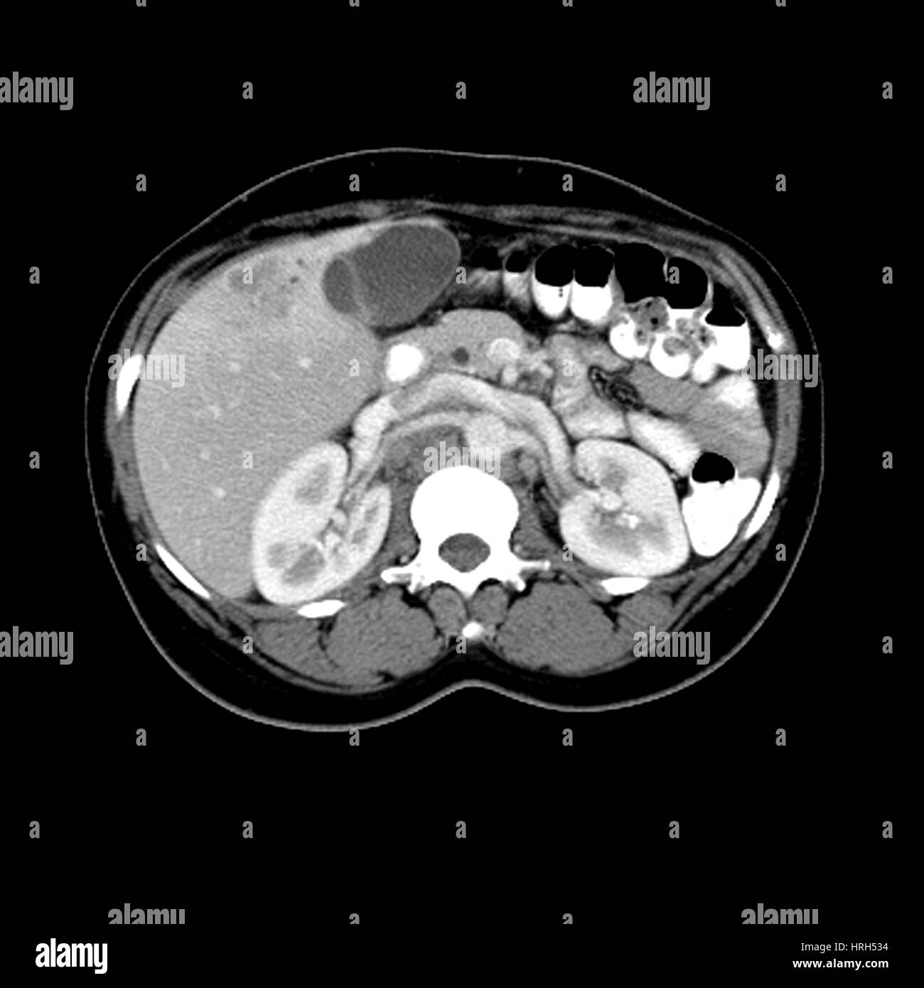 Ct scan der leber -Fotos und -Bildmaterial in hoher Auflösung – Alamy