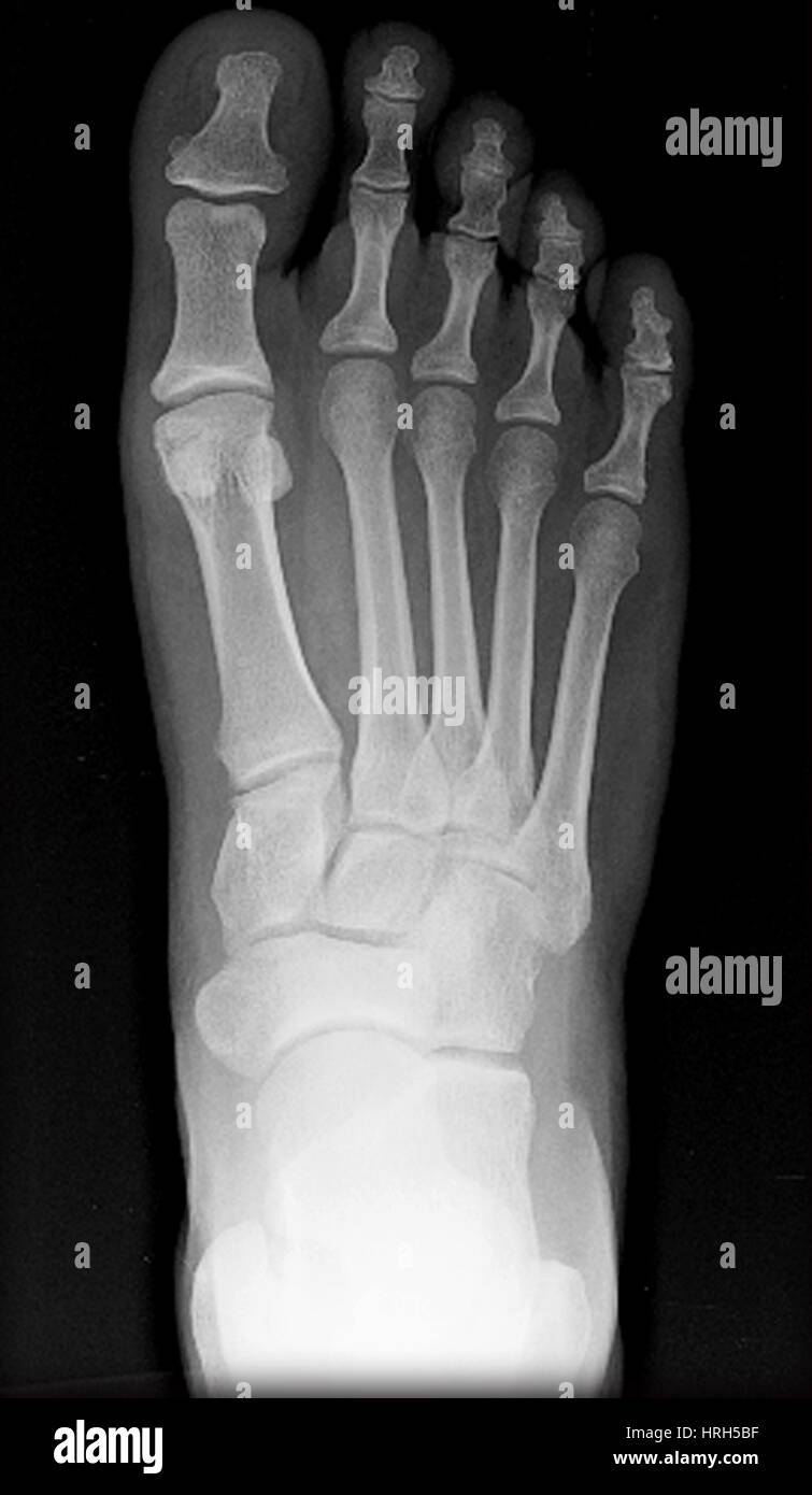 Röntgenbild fuss normal -Fotos und -Bildmaterial in hoher Auflösung – Alamy