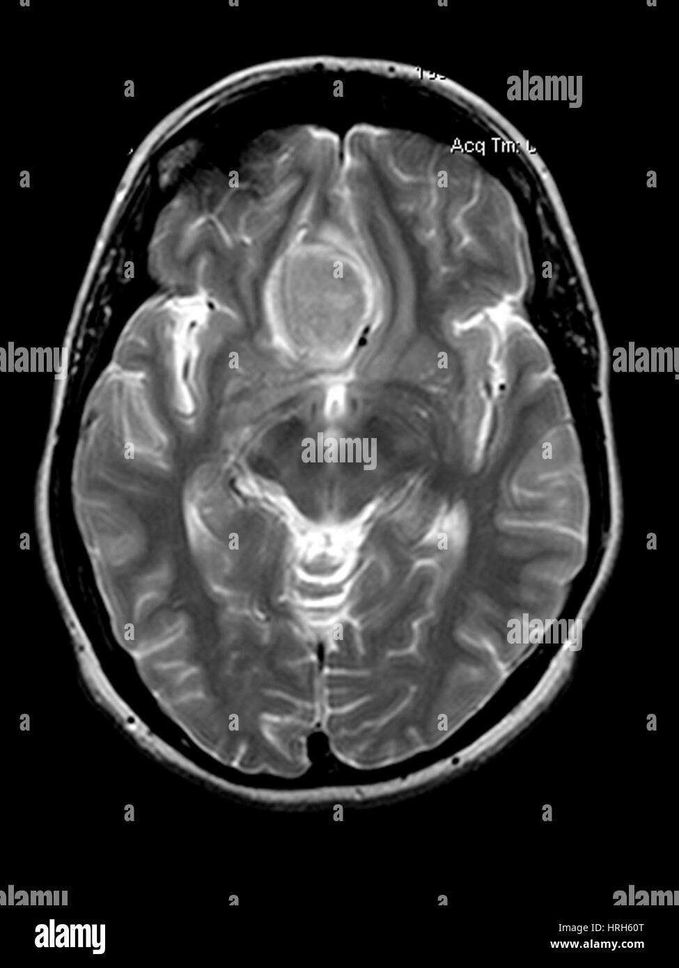 Mri eines meningiom -Fotos und -Bildmaterial in hoher Auflösung – Alamy