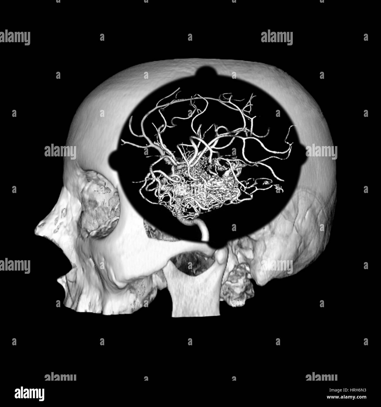 3d angiography of cerebral avm -Fotos und -Bildmaterial in hoher ...