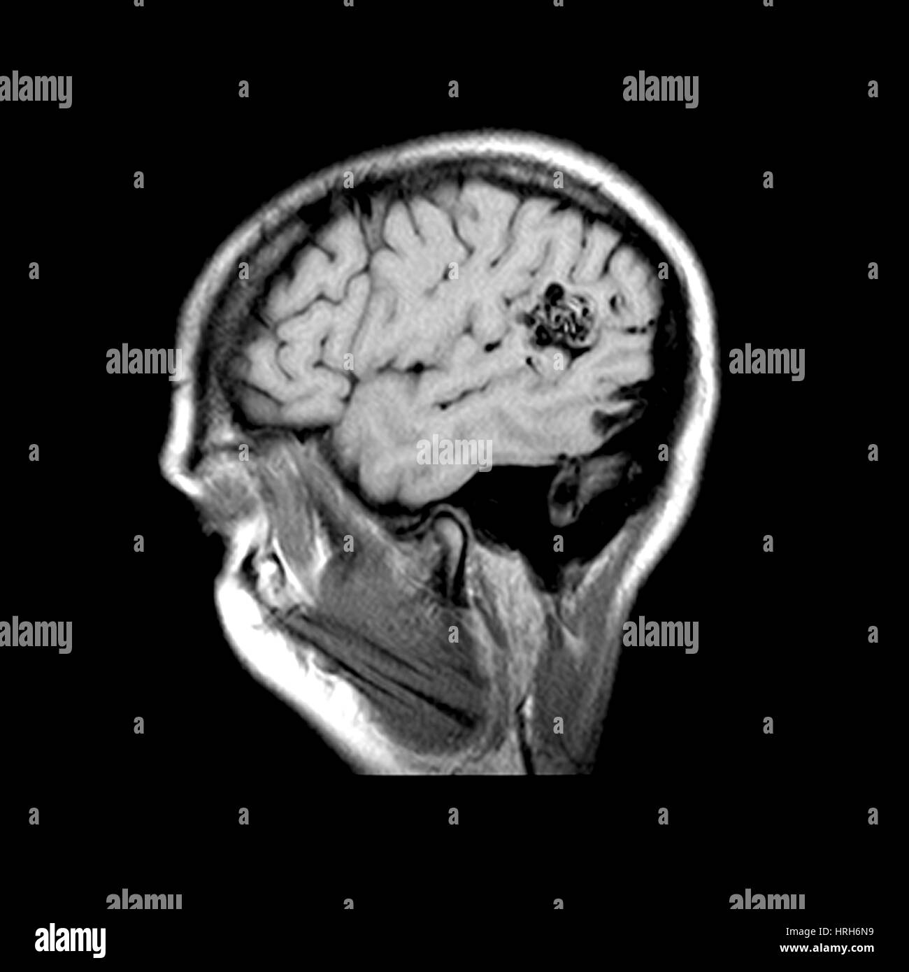 Mri von avm des gehirns -Fotos und -Bildmaterial in hoher Auflösung – Alamy