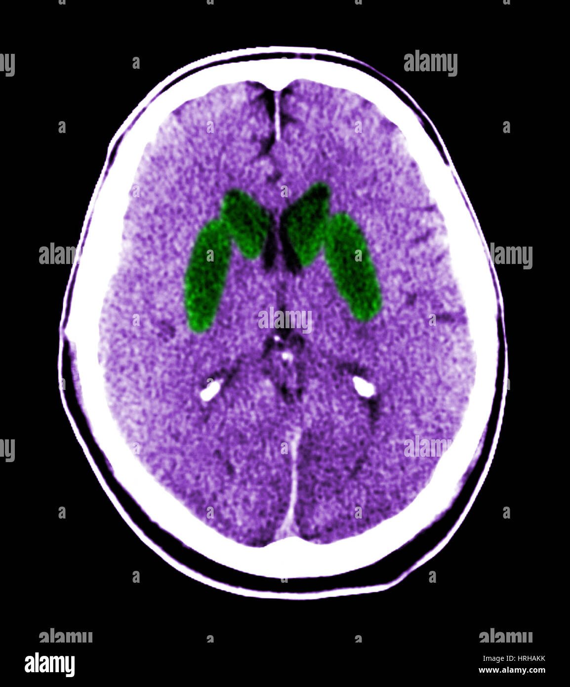 Gehirn hirninfarkt -Fotos und -Bildmaterial in hoher Auflösung – Alamy