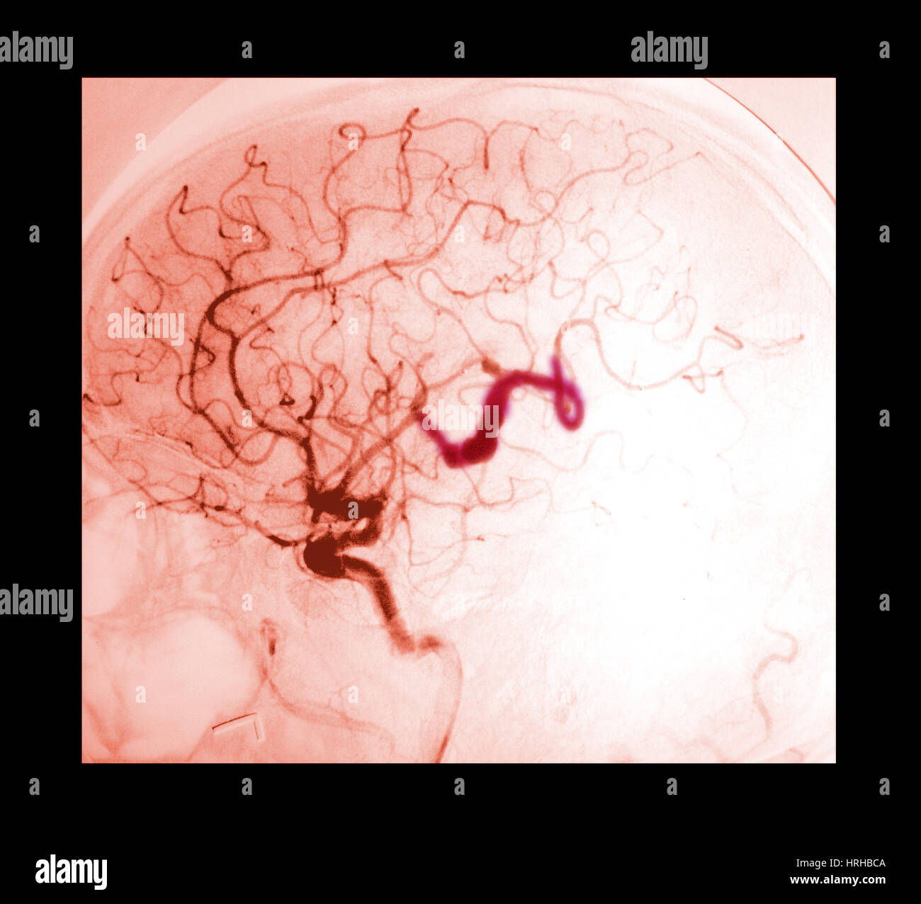 Aneurysma der a carotis interna -Fotos und -Bildmaterial in hoher ...