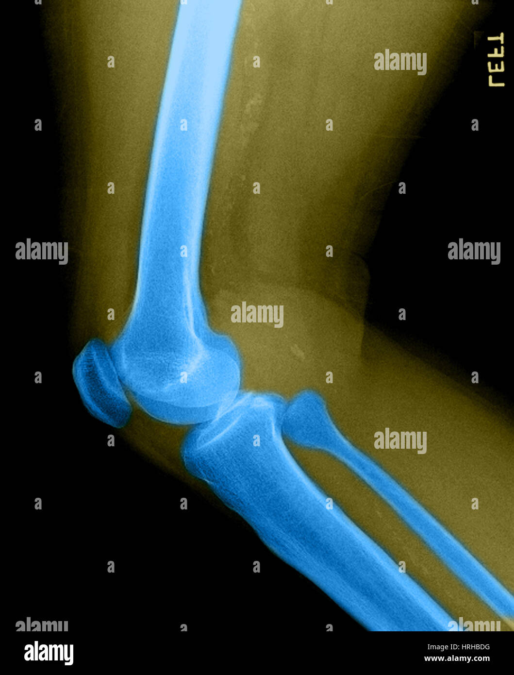 X ray knee lateral -Fotos und -Bildmaterial in hoher Auflösung – Alamy