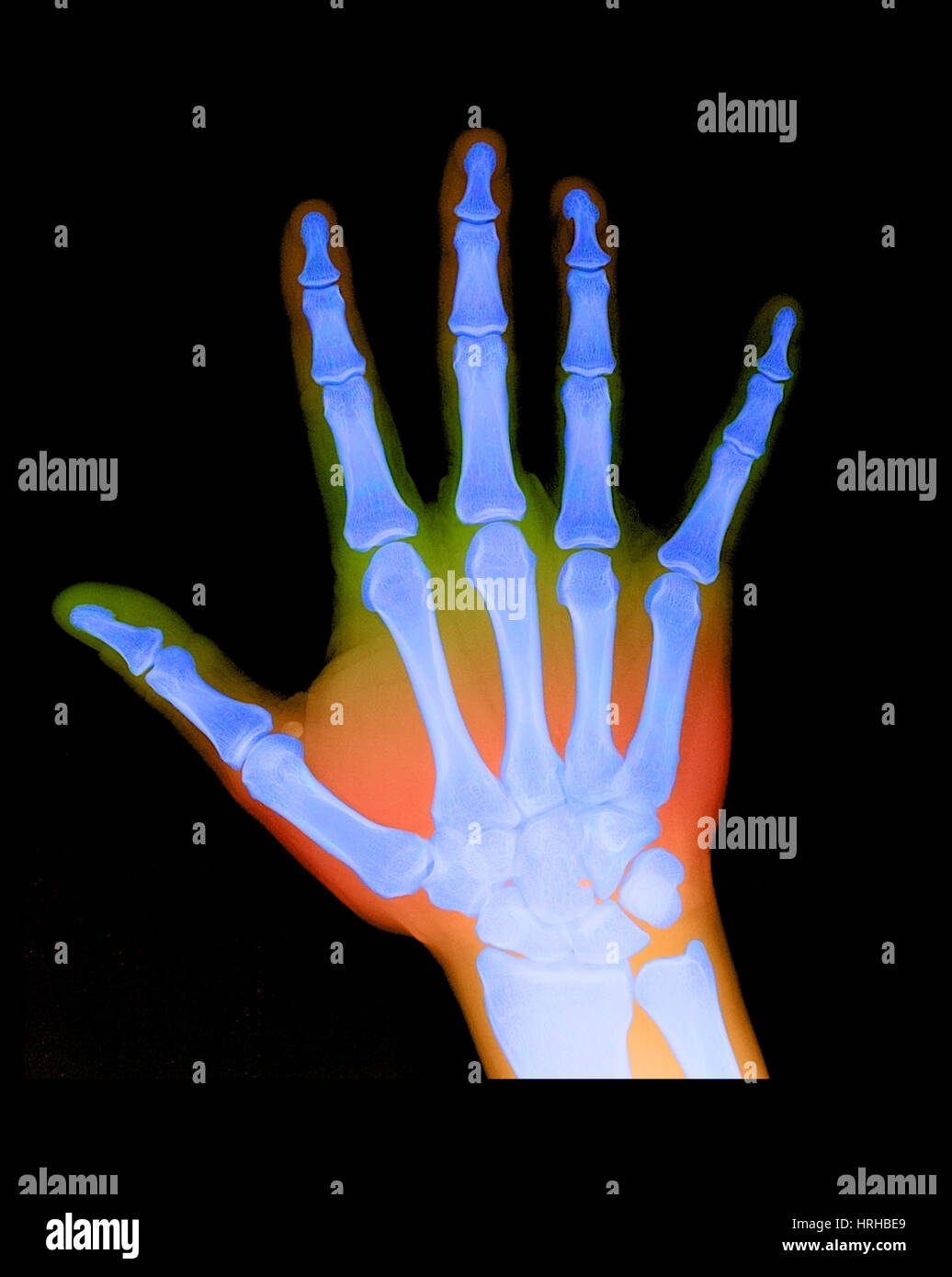 Rontgenbild Einer Hand 1