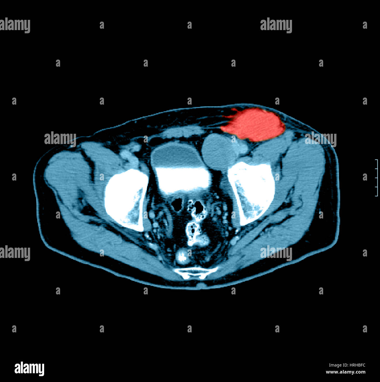 Ct des lymphoms -Fotos und -Bildmaterial in hoher Auflösung – Alamy