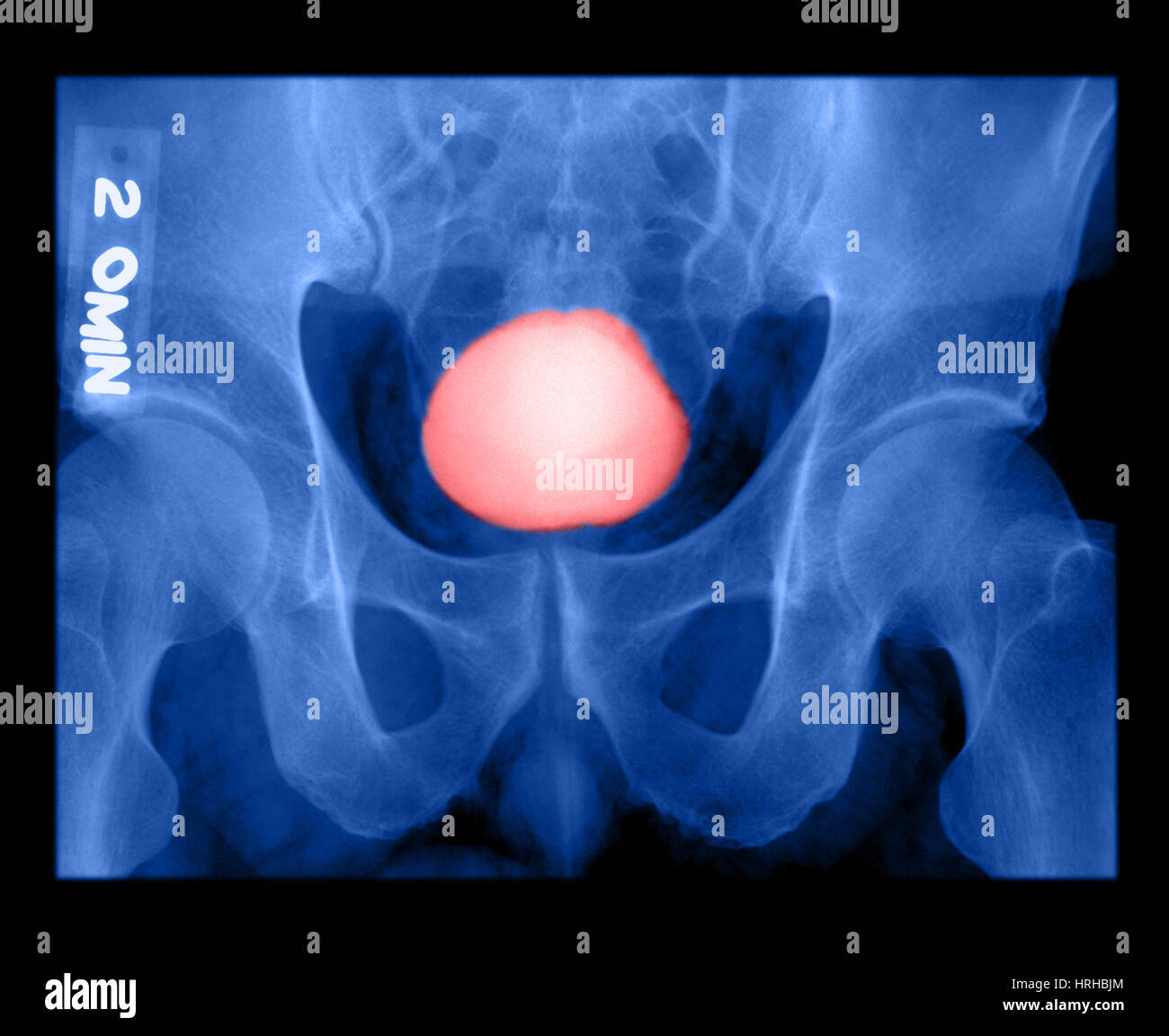 Normal xray of urinary system -Fotos und -Bildmaterial in hoher ...