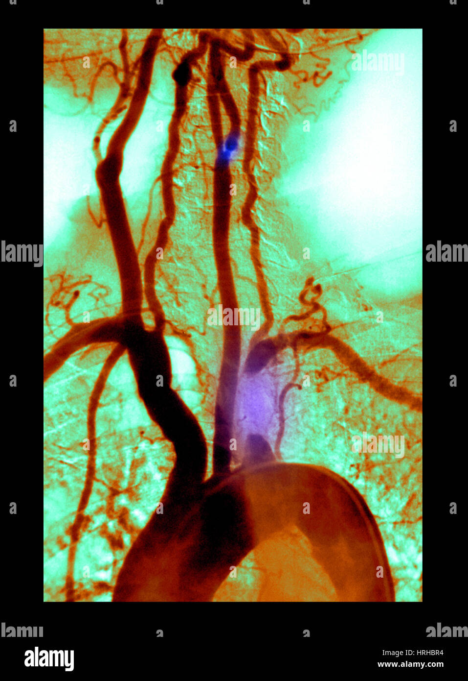 Carotid angiogram -Fotos und -Bildmaterial in hoher Auflösung – Alamy
