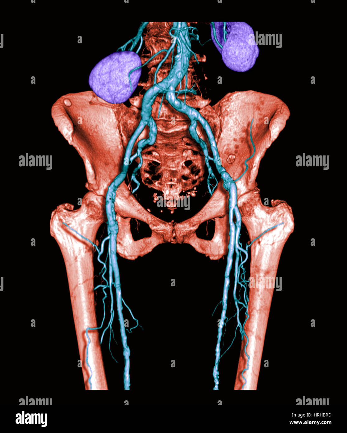 Angiogramm der beine -Fotos und -Bildmaterial in hoher Auflösung – Alamy