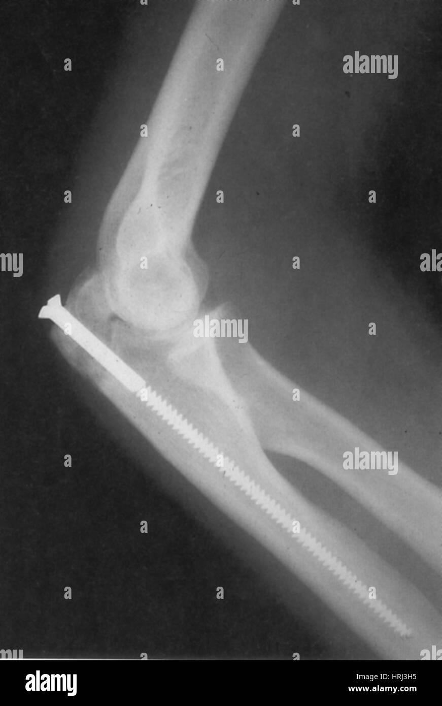 Offene fraktur arm -Fotos und -Bildmaterial in hoher Auflösung – Alamy