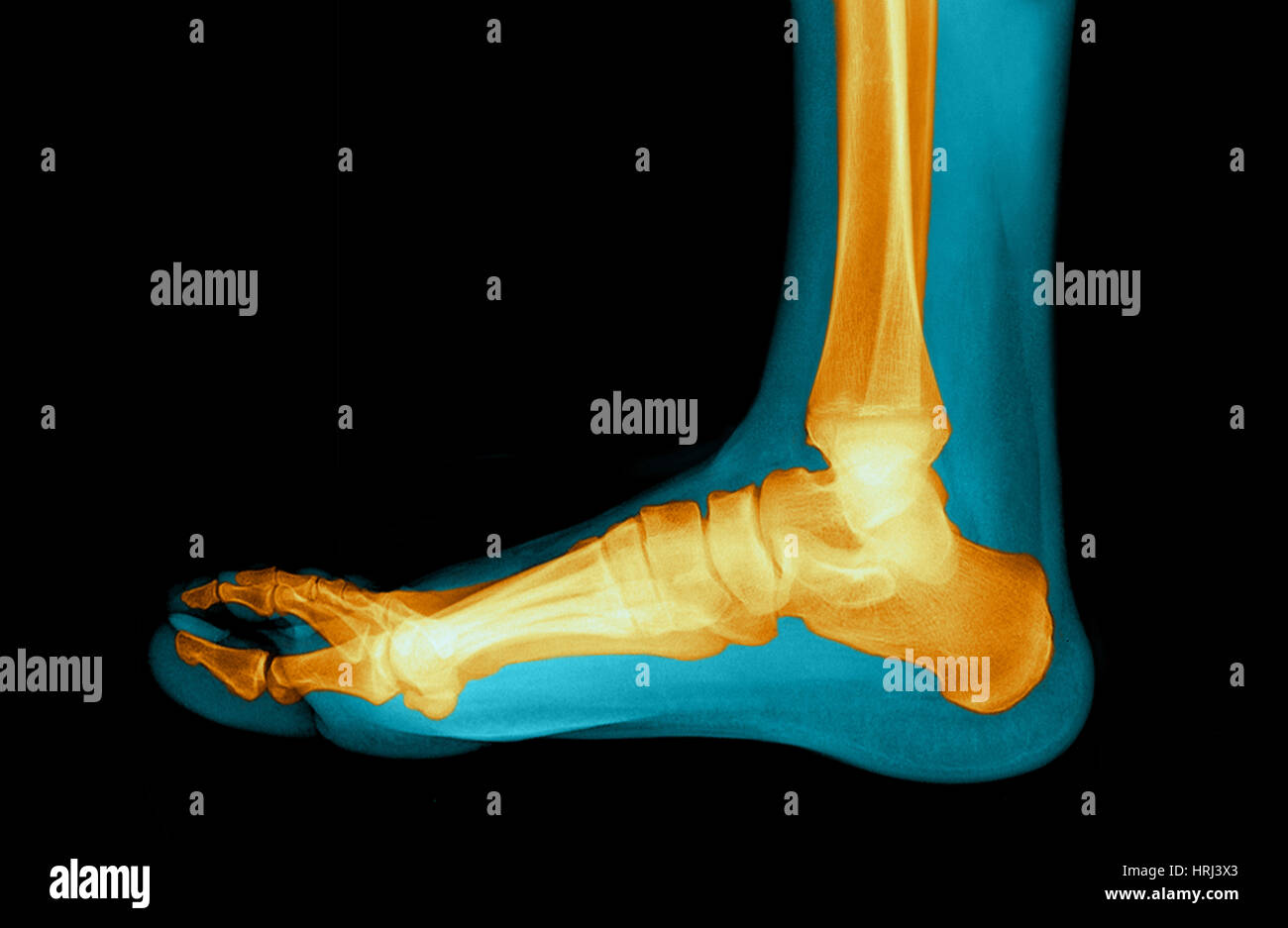 Foot bones x rays -Fotos und -Bildmaterial in hoher Auflösung – Alamy