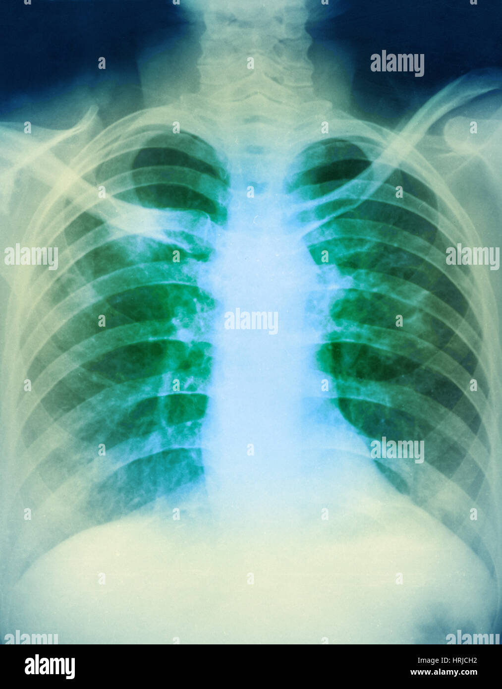 Hodgkins lymphoma -Fotos und -Bildmaterial in hoher Auflösung – Alamy