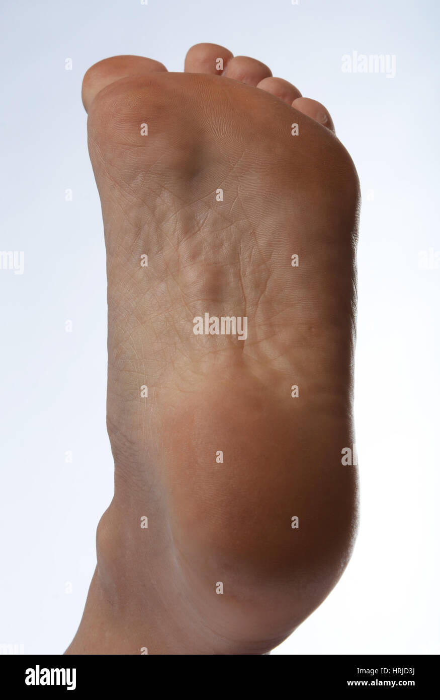 Morbus ledderhose -Fotos und -Bildmaterial in hoher Auflösung – Alamy