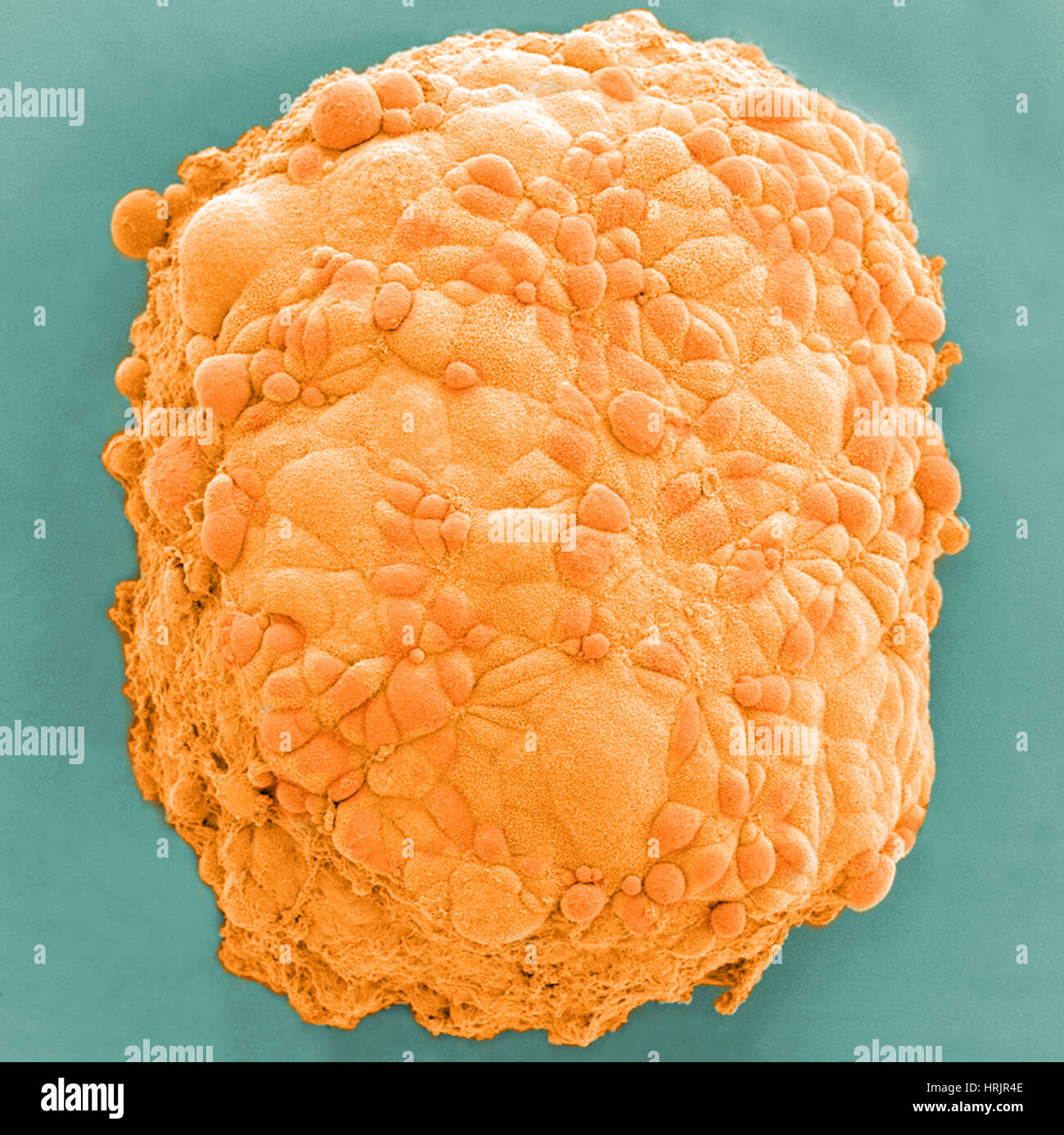 Stage Iiib Squamous Cell Carcinoma Of The Cervix Icd 10