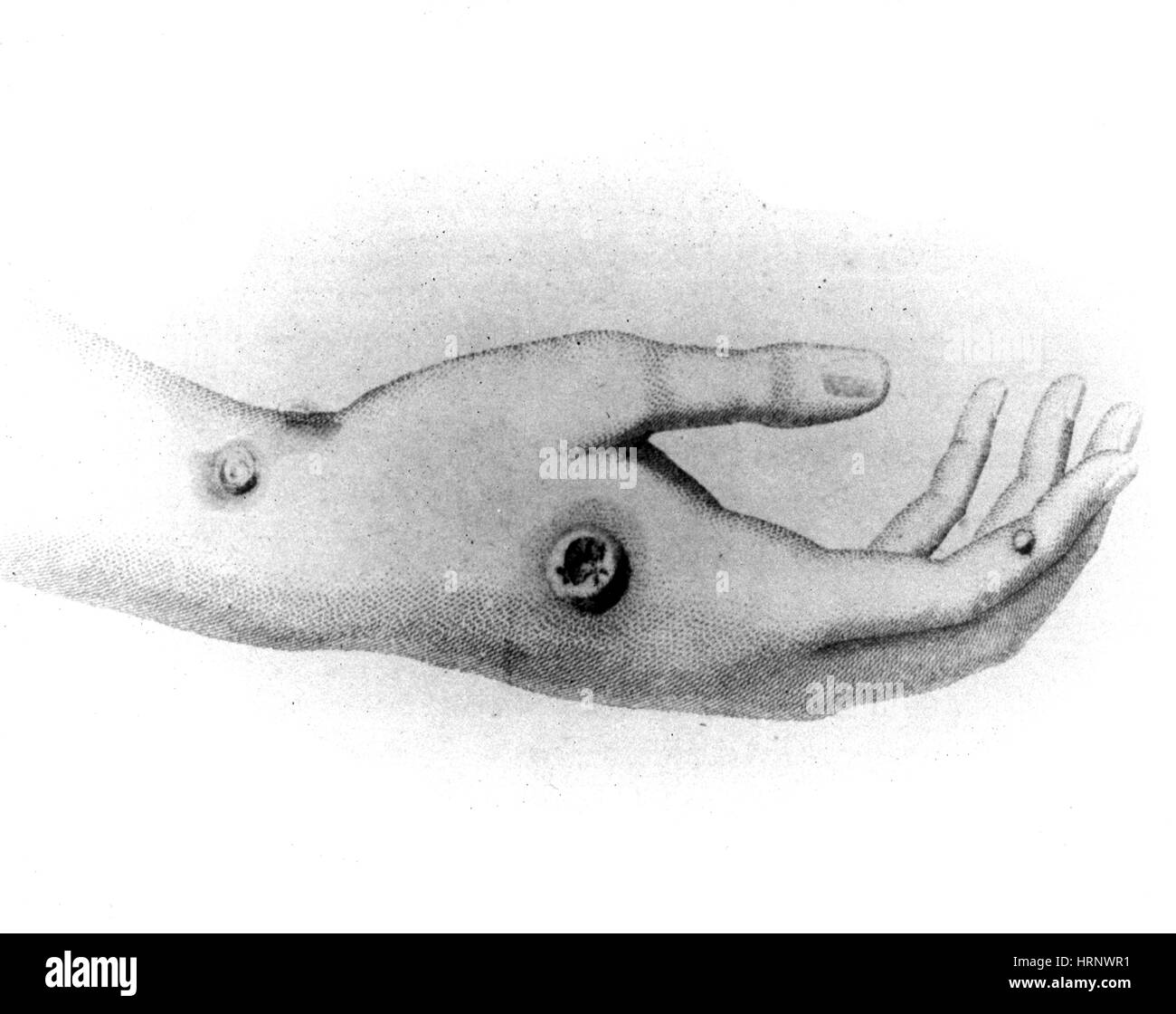 Smallpox lesions -Fotos und -Bildmaterial in hoher Auflösung – Alamy