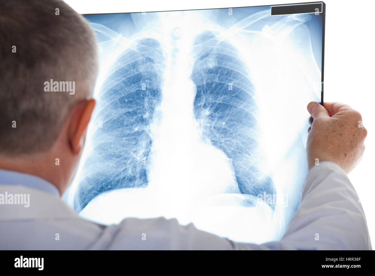 Bronchitis radiography -Fotos und -Bildmaterial in hoher Auflösung – Alamy