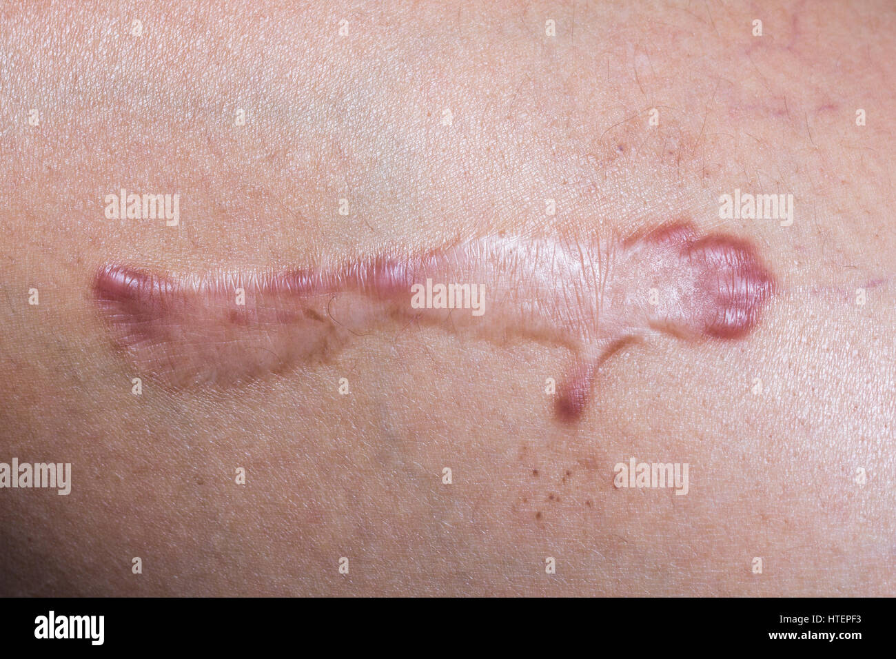 Narbe am bein -Fotos und -Bildmaterial in hoher Auflösung - Seite 2 - Alamy