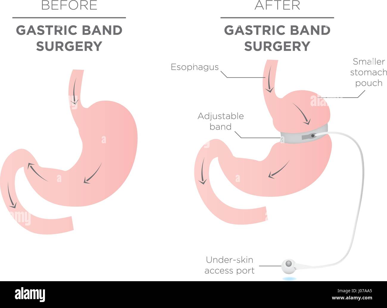 Bariatrische chirurgie -Fotos und -Bildmaterial in hoher Auflösung – Alamy
