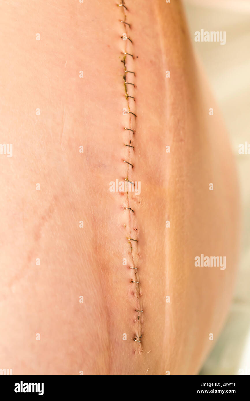 Lange narbe -Fotos und -Bildmaterial in hoher Auflösung – Alamy