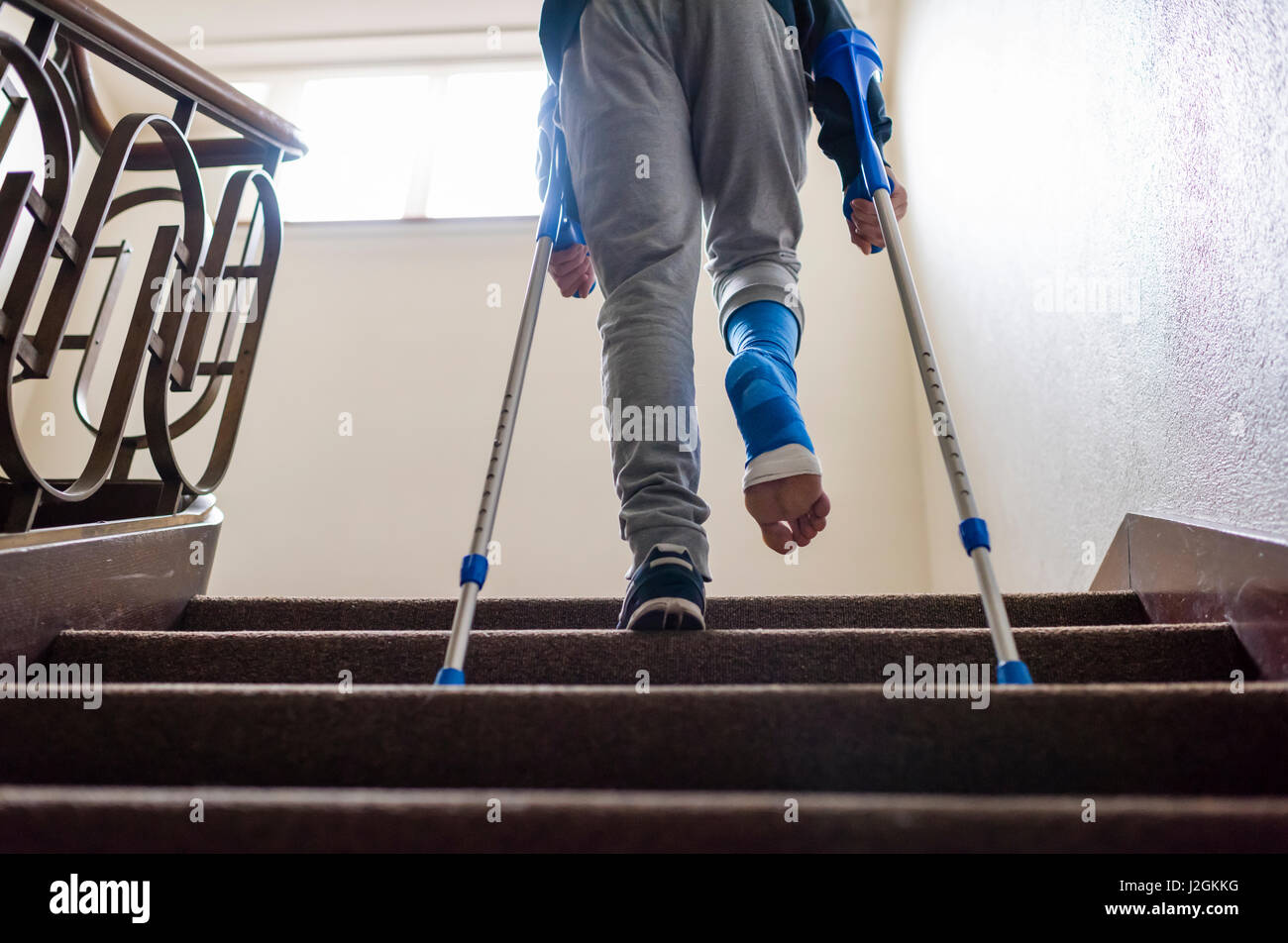 Gipsfuß Gegossen Stockfotos und -bilder Kaufen - Alamy