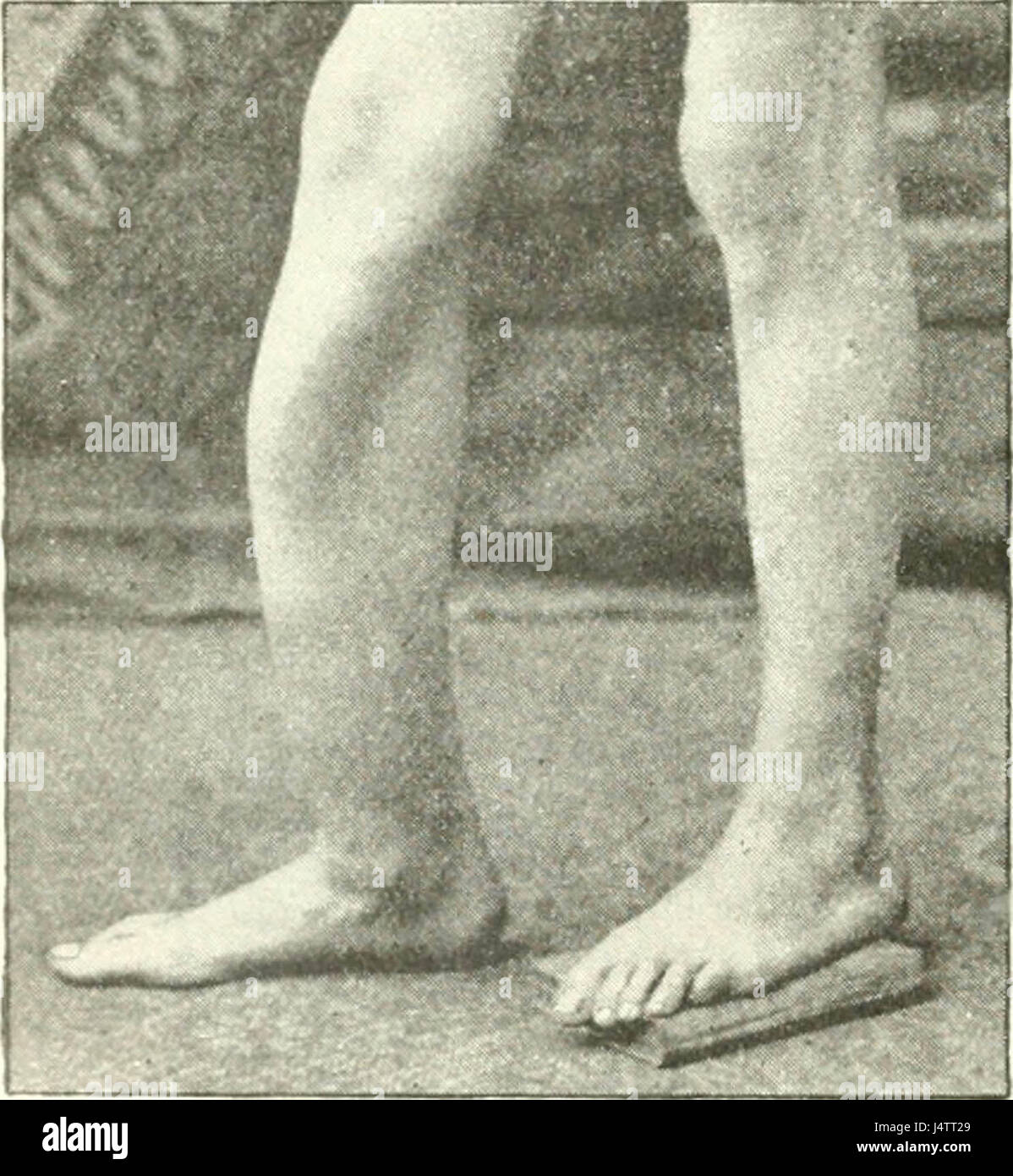 "Hermaphroditismus Beim Menschen" (1908 Stockfotografie - Alamy
