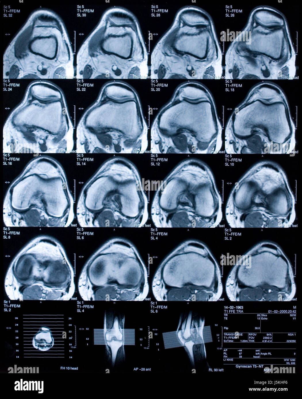 Mri knee -Fotos und -Bildmaterial in hoher Auflösung – Alamy