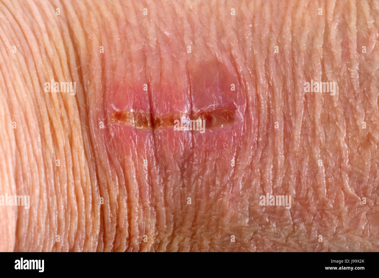 Wunde heilungsprozess -Fotos und -Bildmaterial in hoher Auflösung – Alamy