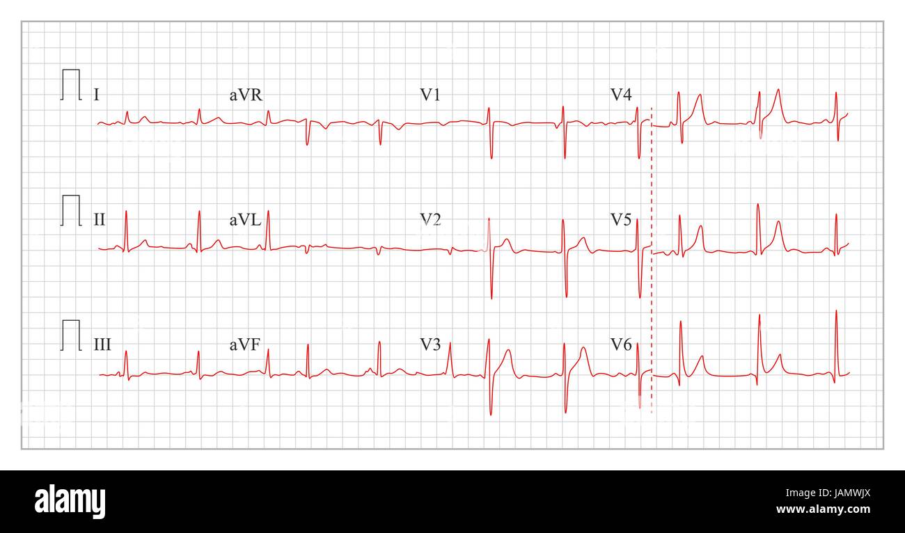 Herz EKG Diagramm Vektor. Gesundes Herz Rhythmus, Ischämie, Infarkt ...