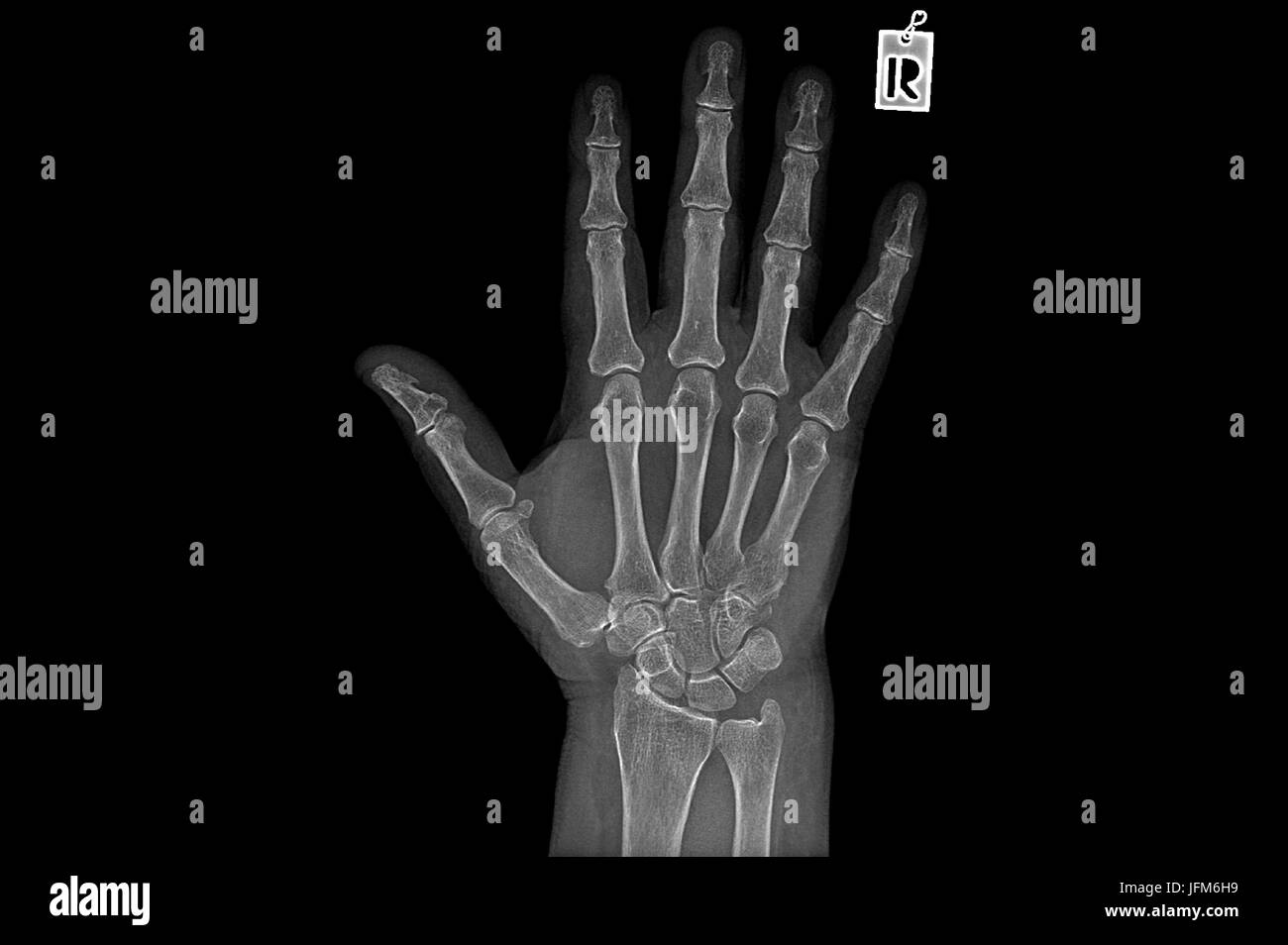 X ray radiograph hand -Fotos und -Bildmaterial in hoher Auflösung ...