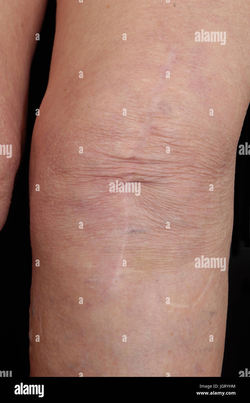 Knee surgery scar -Fotos und -Bildmaterial in hoher Auflösung - Seite 2 ...