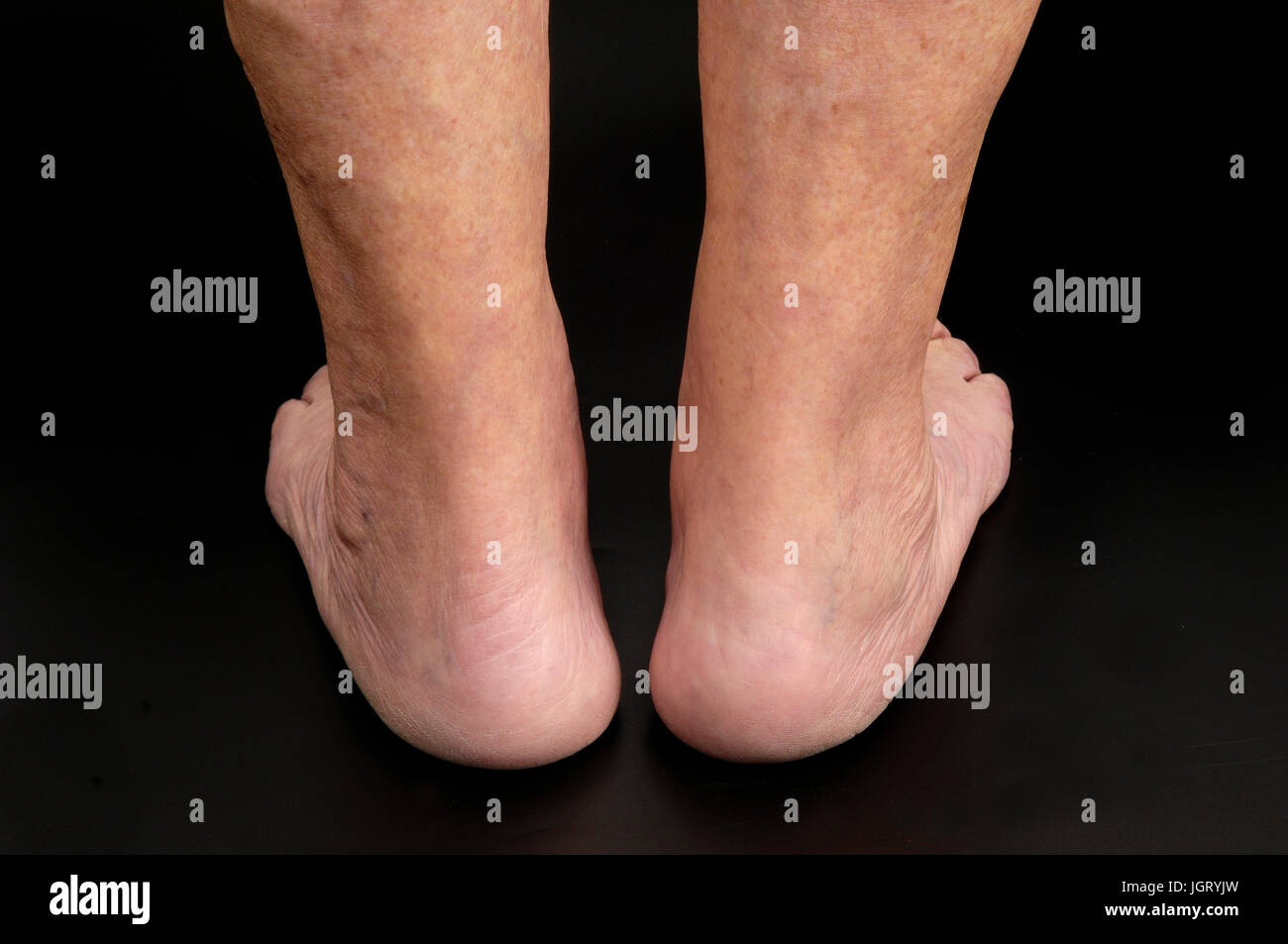 Achilles tendon -Fotos und -Bildmaterial in hoher Auflösung – Alamy