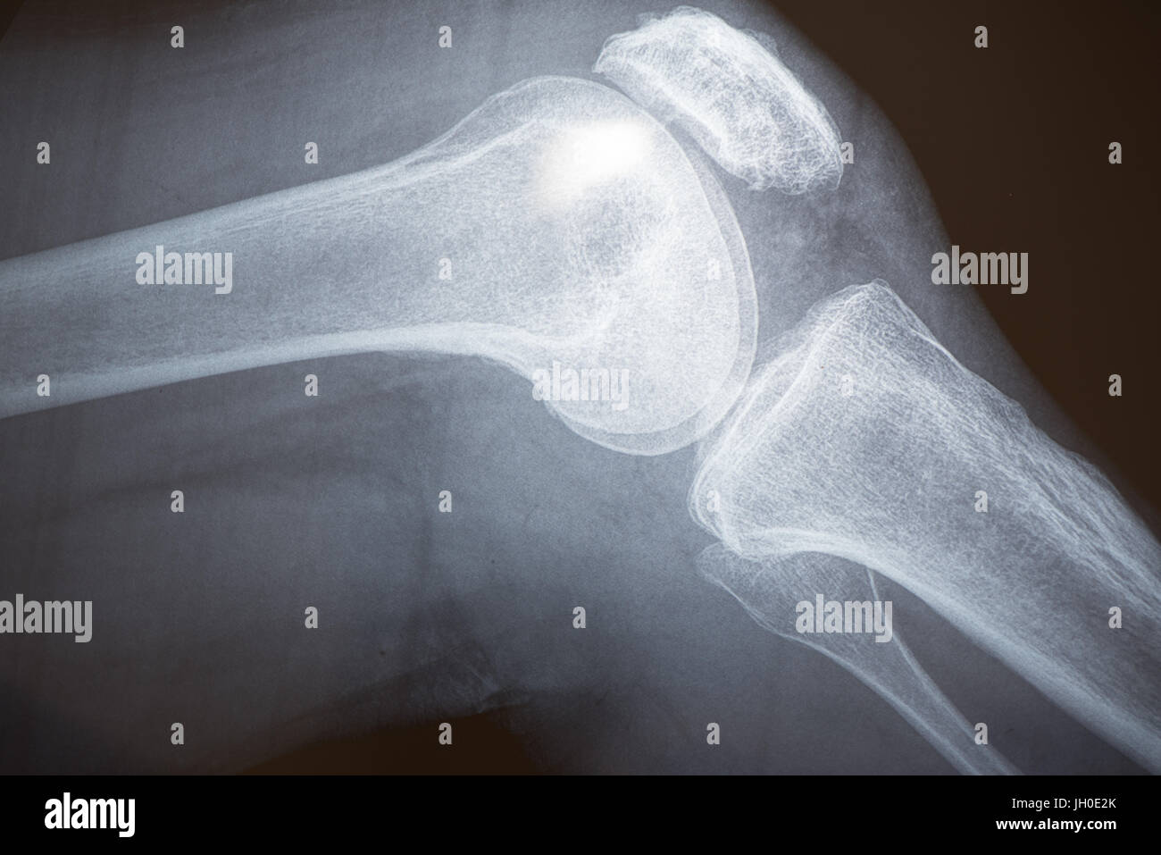 Röntgenaufnahme Knie Knochen Stockfotografie - Alamy