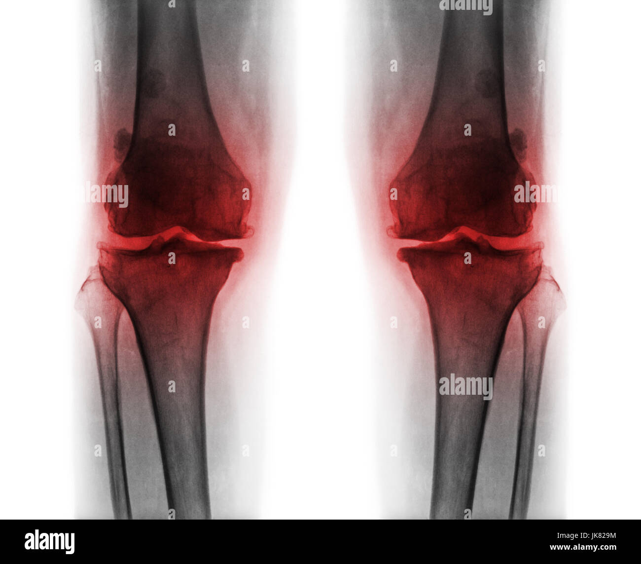 Arthrose, die beide Knie. Film x-ray AP (anterior - posterior) Knie ...