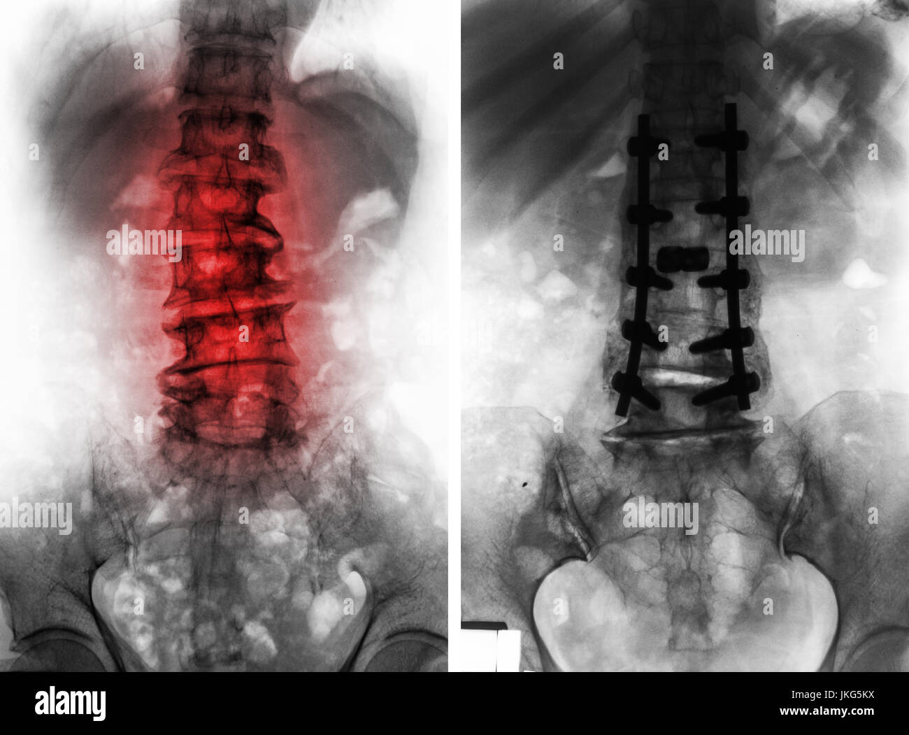 Lumbar spondylolisthesis -Fotos und -Bildmaterial in hoher Auflösung ...