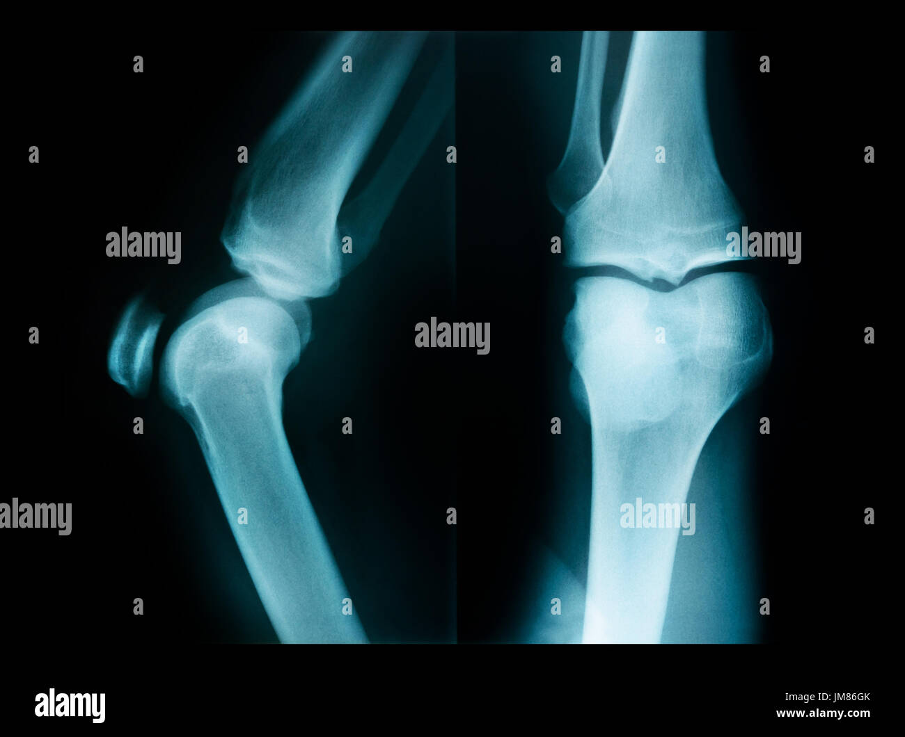Knee prosthesis x ray -Fotos und -Bildmaterial in hoher Auflösung – Alamy