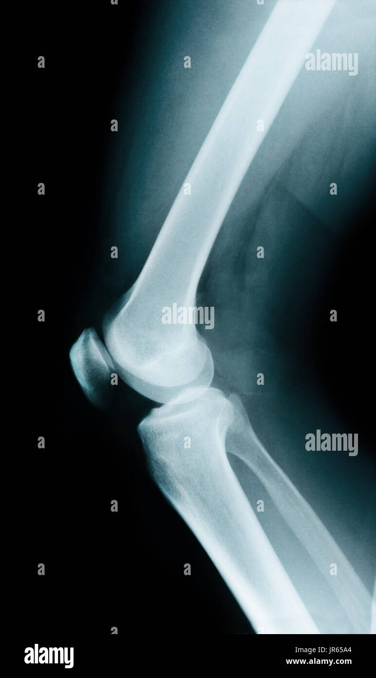 Knie Knochen Anatomie x-ray Stockfotografie - Alamy