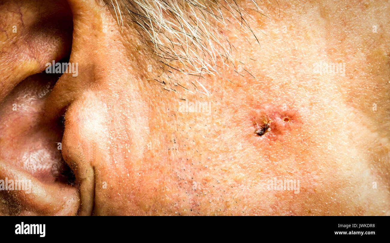 Basal Cell Carcinoma Stockfotos und -bilder Kaufen - Alamy