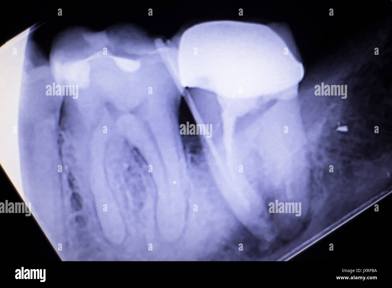 Dental xray-Scan der Zahn mit Krone füllen und Wurzelbehandlung ...