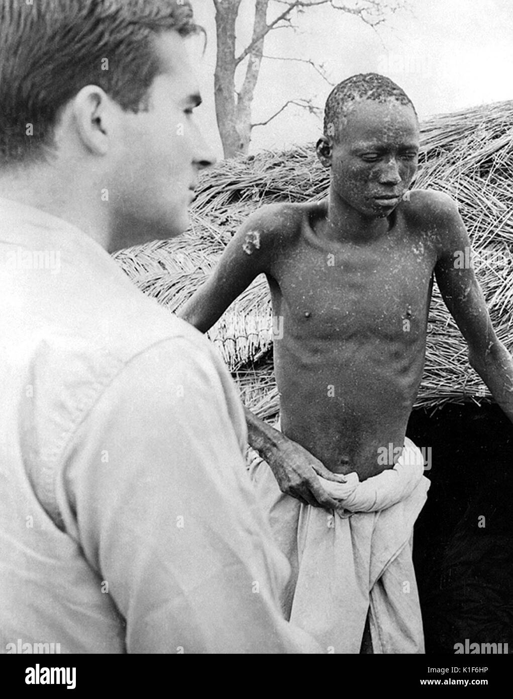 Pocken ausbruch -Fotos und -Bildmaterial in hoher Auflösung – Alamy