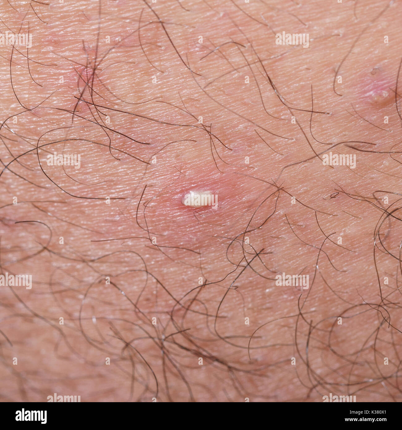 Pus abscess -Fotos und -Bildmaterial in hoher Auflösung – Alamy