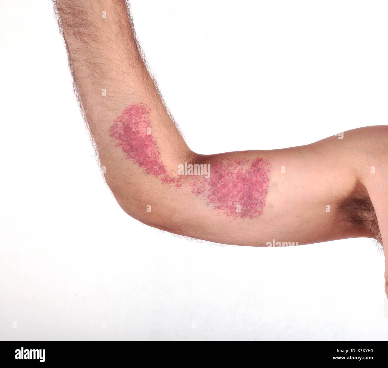 Hämatom hand -Fotos und -Bildmaterial in hoher Auflösung – Alamy