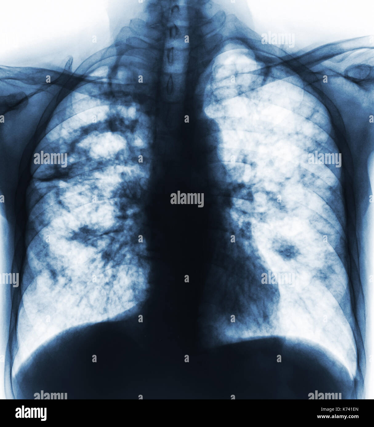 Lungentuberkulose. Film x-ray in der Brust zeigen Hohlraum an rechten ...