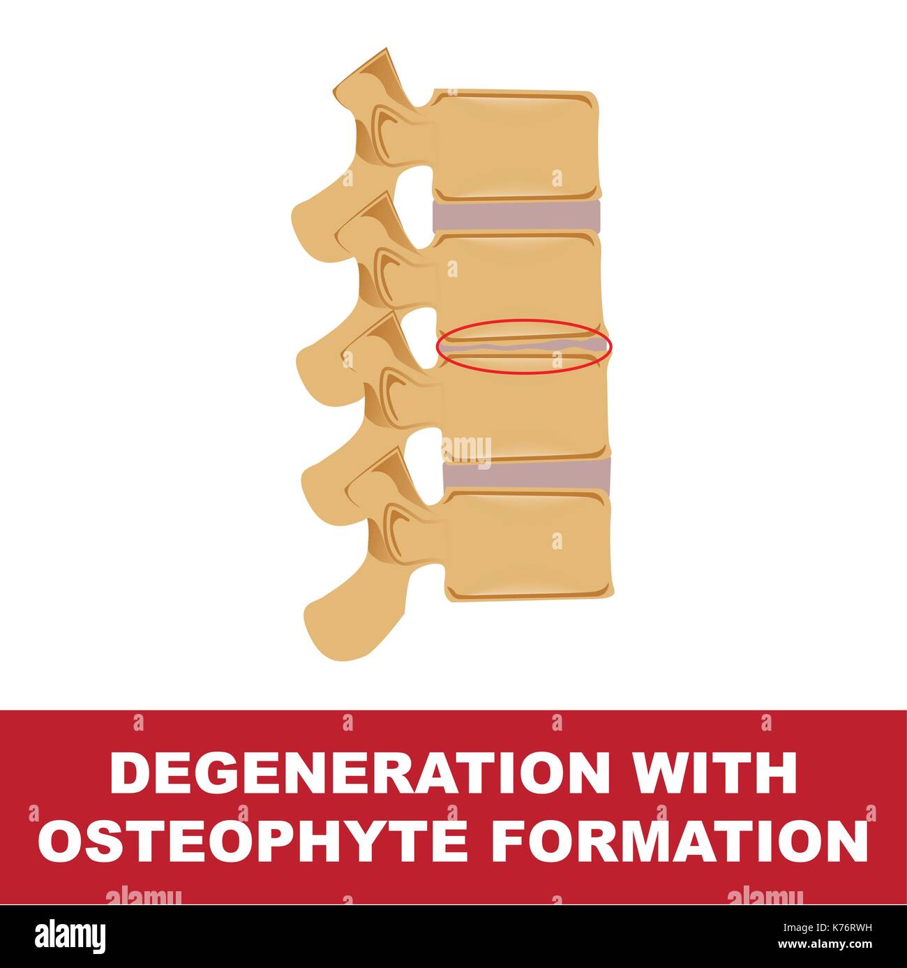 Die Disc Degeneration. Degeneration mit osteophyt Bildung. Vektor ...