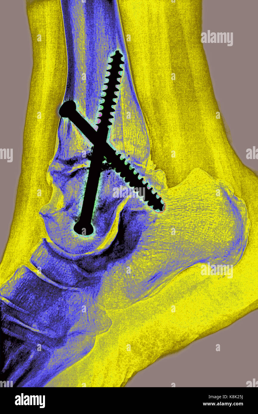 KNÖCHEL OSTEOSYNTHESE, X-RAY Stockfotografie - Alamy