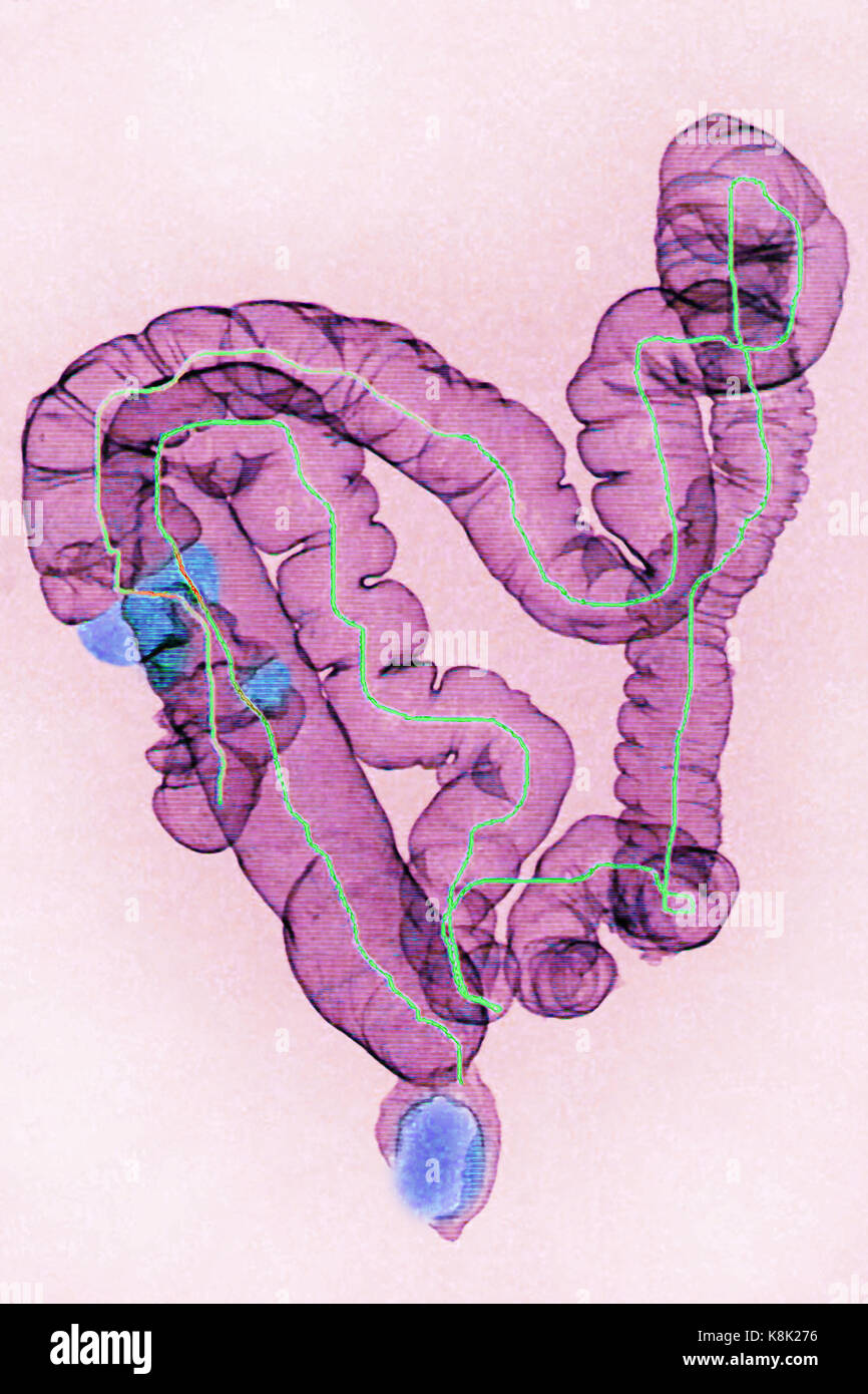Darmkrebs CT-Scan Stockfotografie - Alamy