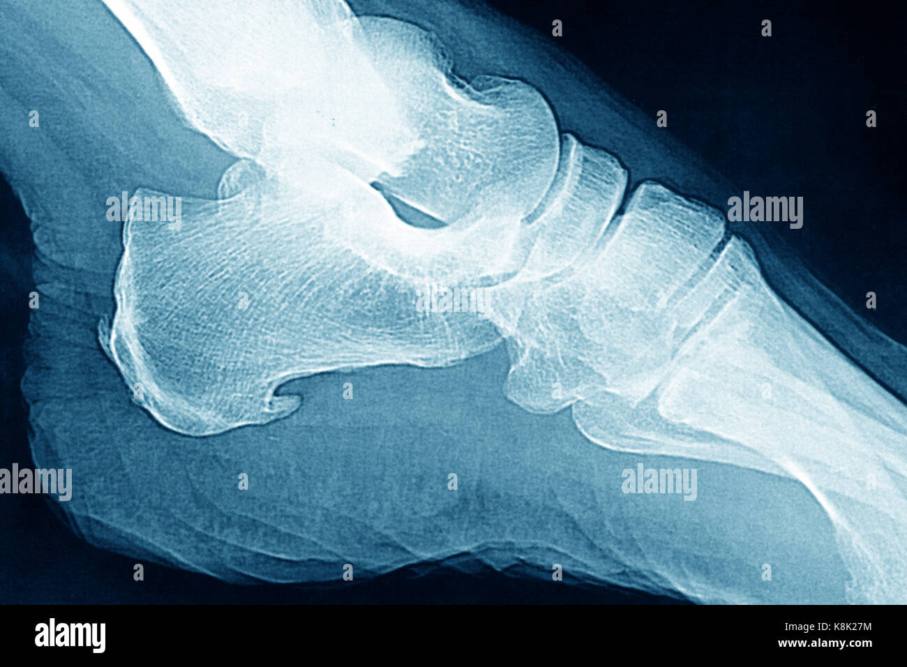 ENTHESOPATHY X-RAY Stockfotografie - Alamy