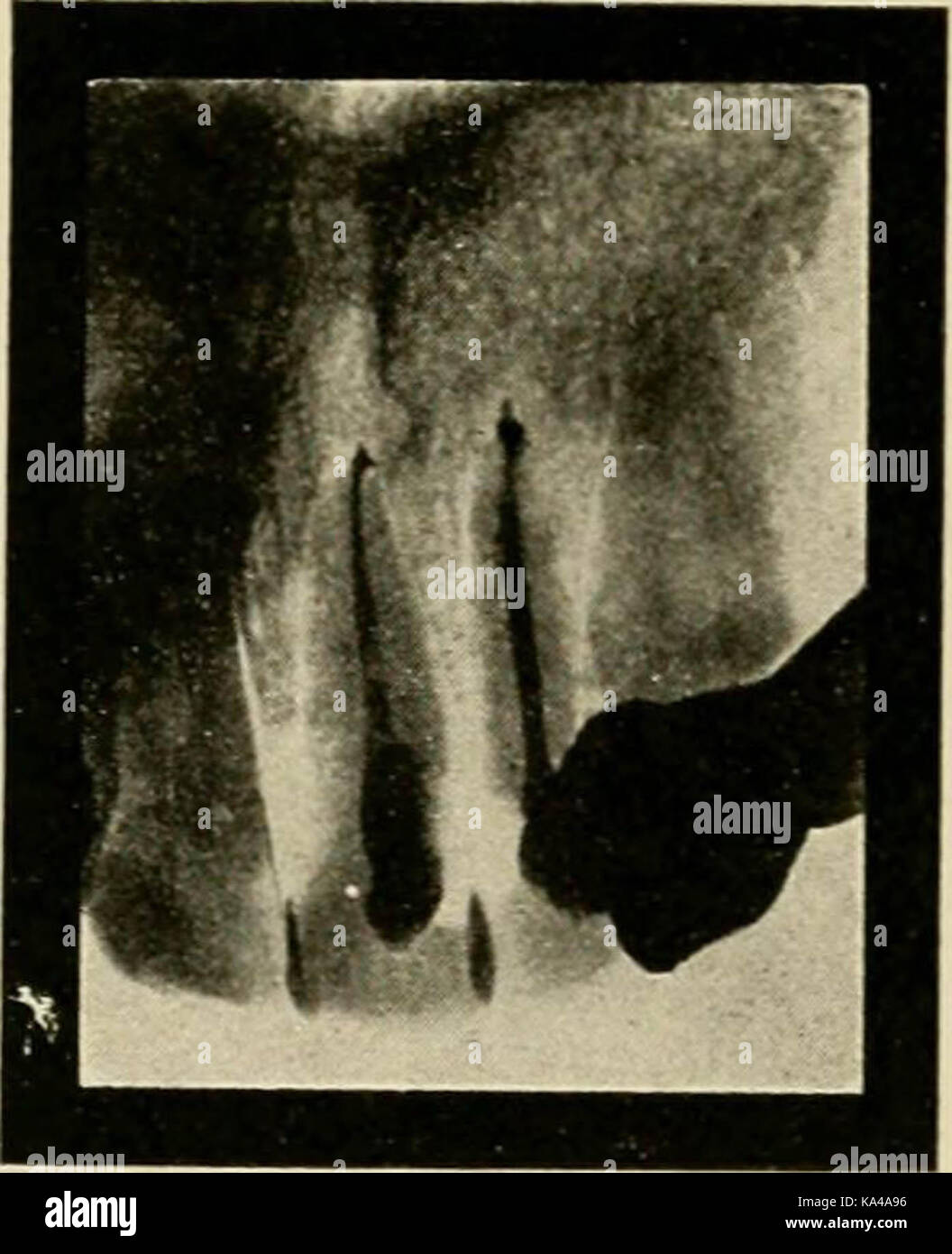 Elementare und dentale radiographie von howard riley raper 1918 -Fotos ...